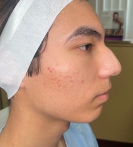 BBL Forever Clear (treating Acne) - Affiliated Troy Dermatologists