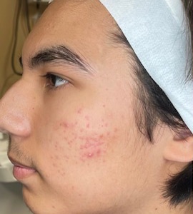 BBL Forever Clear (treating Acne) - Affiliated Troy Dermatologists