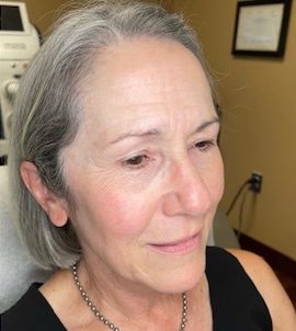 BBL (treating Rosacea) - Affiliated Troy Dermatologists