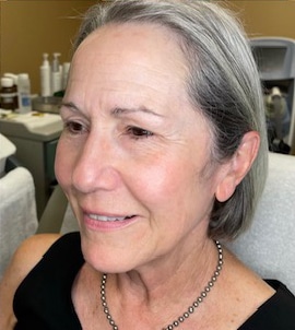 BBL (treating Rosacea) - Affiliated Troy Dermatologists